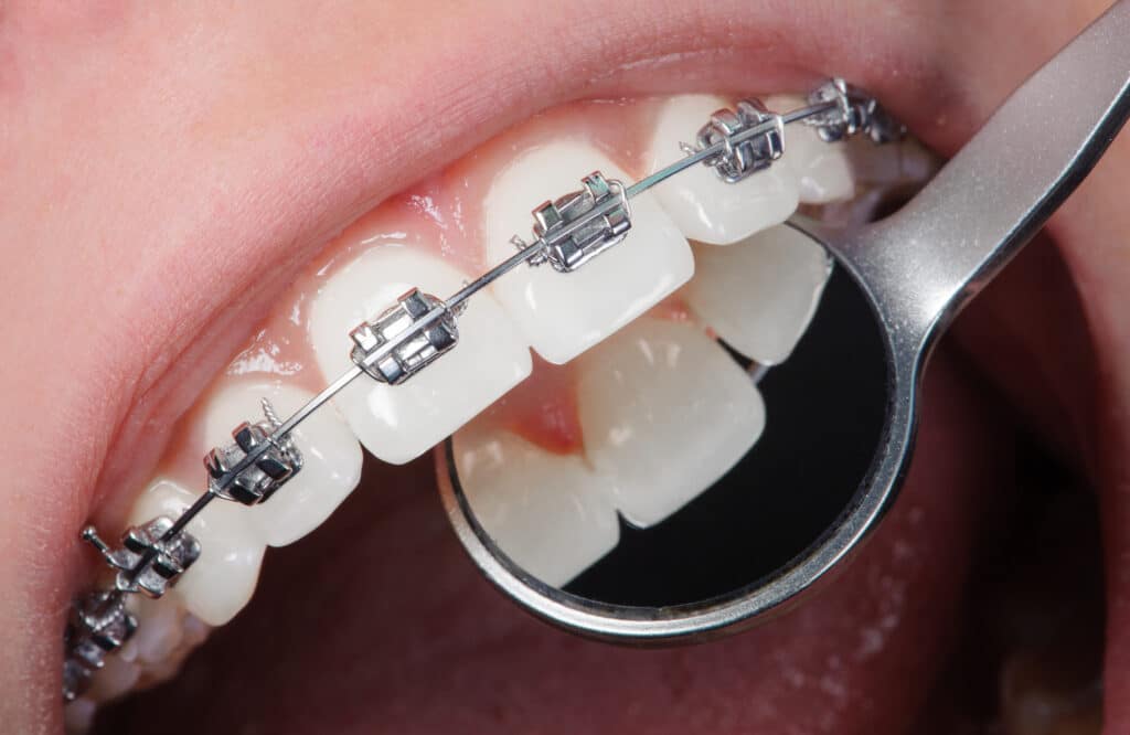 Fixed Braces - Orthoclinic